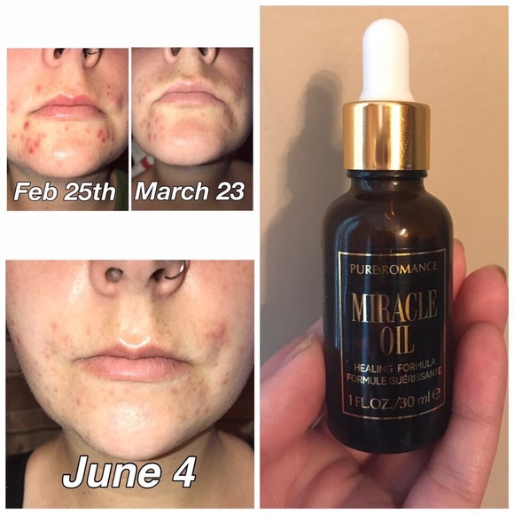 Pure Romance | Other | Miracle Oil By Pure Romance | Poshmark